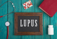 Lupus je autoimuna bolest, a ovo su najčešći simptomi