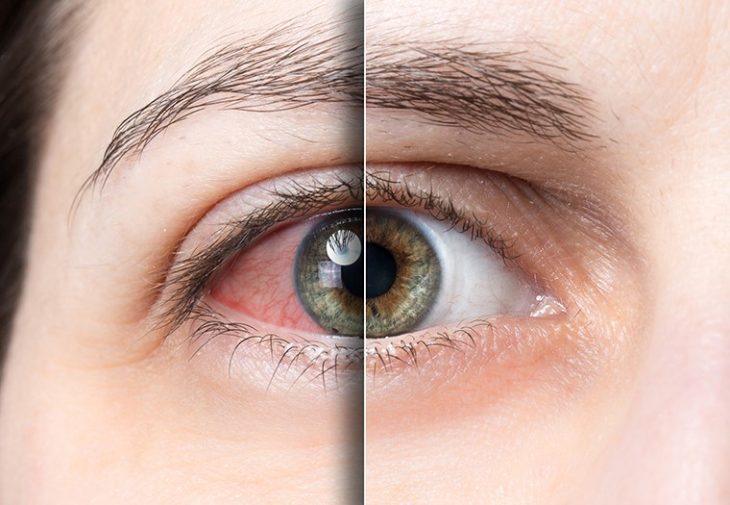 Konjuktivitis: zbog čega se crvene naše oči i kako si možemo pomoći?