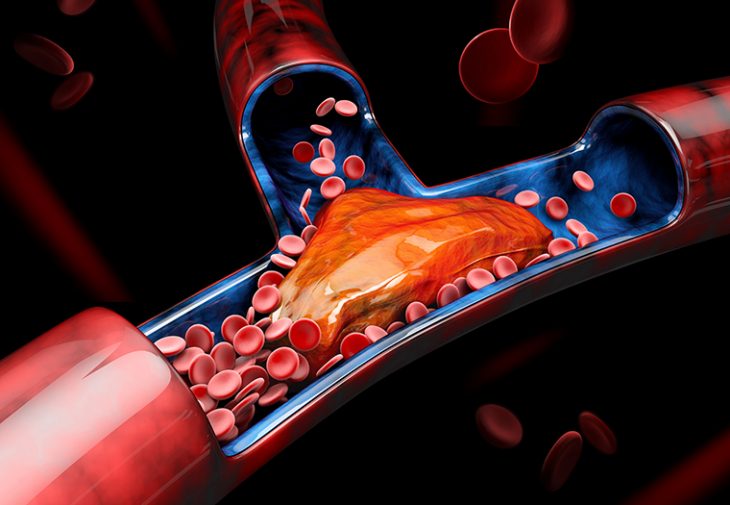 Prepoznajte pravovremeno rizik za nastajanje plućne embolije