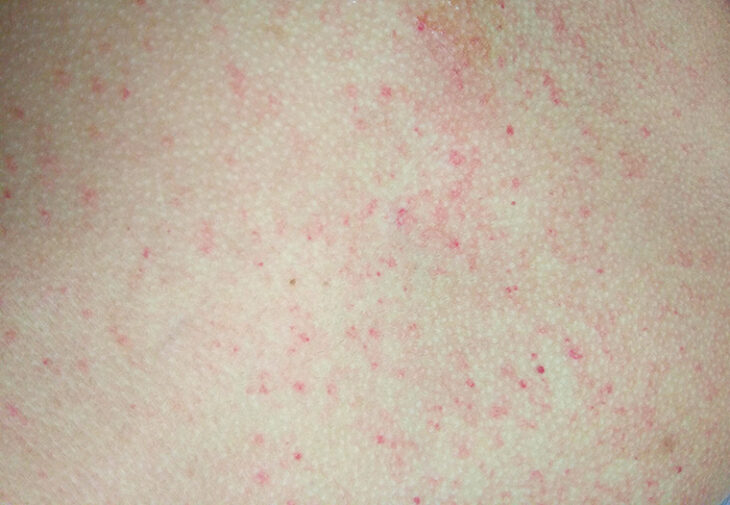 Obiteljsko zdravlje: Što su to petehije i zašto se pojavljuju?