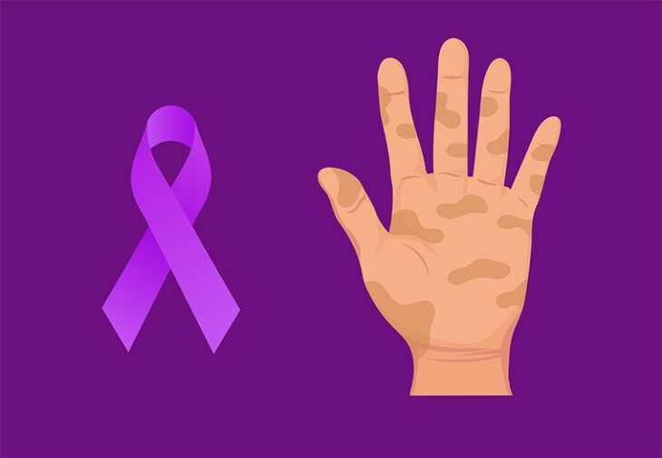 Svjetski dan lepre: drevna bolest koja nije posve nestala