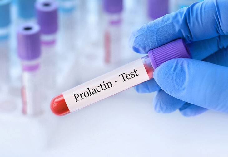Što znači povišen prolaktin te kada i zašto je potrebno liječenje?